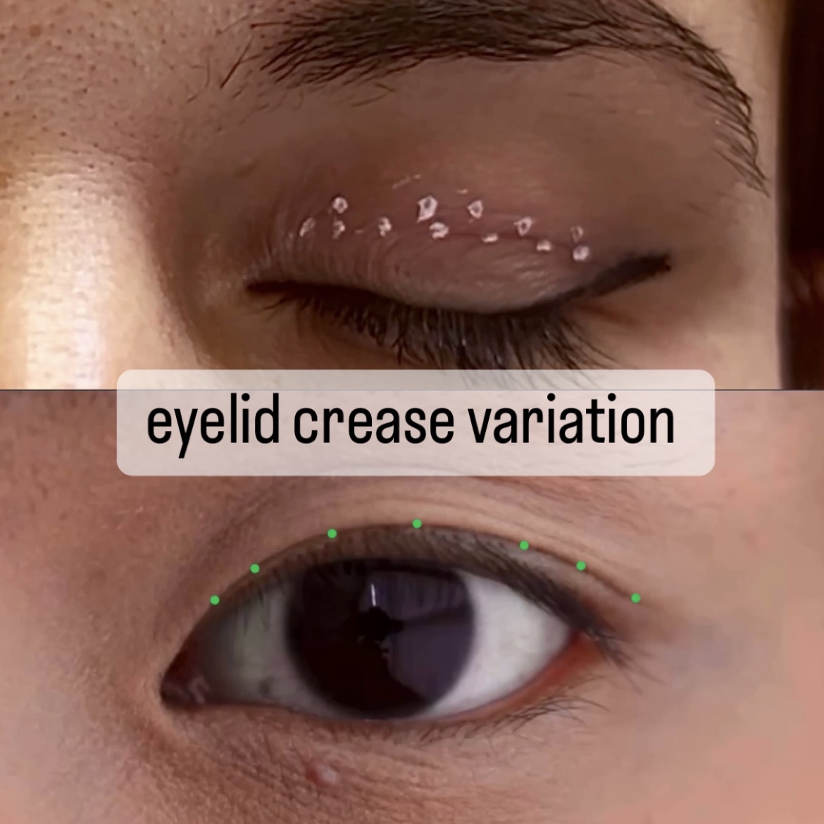 Eyelid Crease Variation - Face the FACS